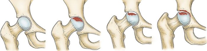 Sheikh Bipolar Cup Orthopedic Prosthetics - Iran2africa
